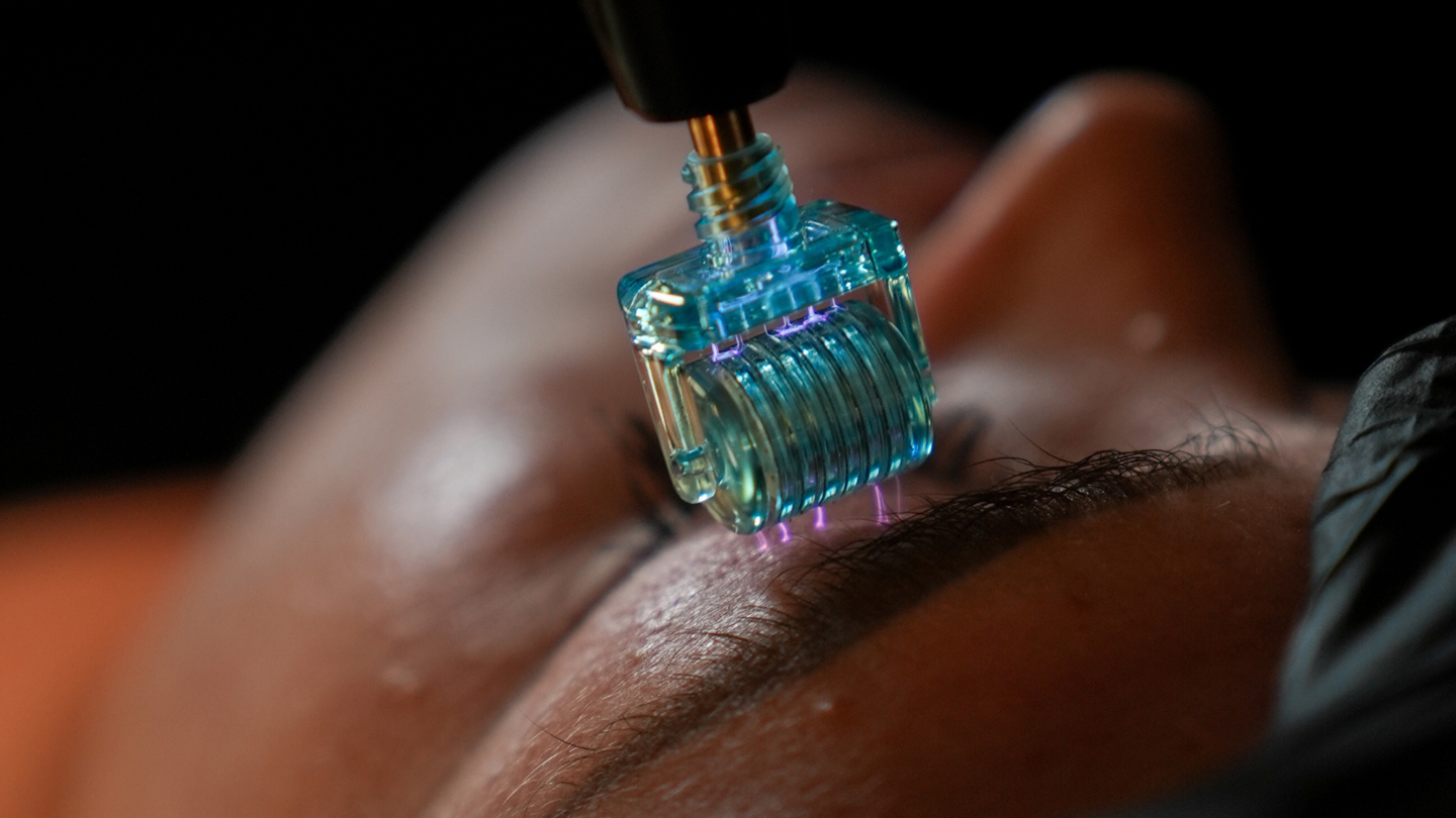 Scar Revision Treatment - Plasma Pen